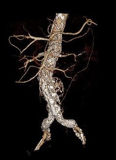 Tech News: Physician-Modified Endografts for Endovascular Repair of ...